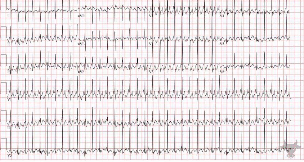 Supraventricular Tachycardia | ECG Stampede