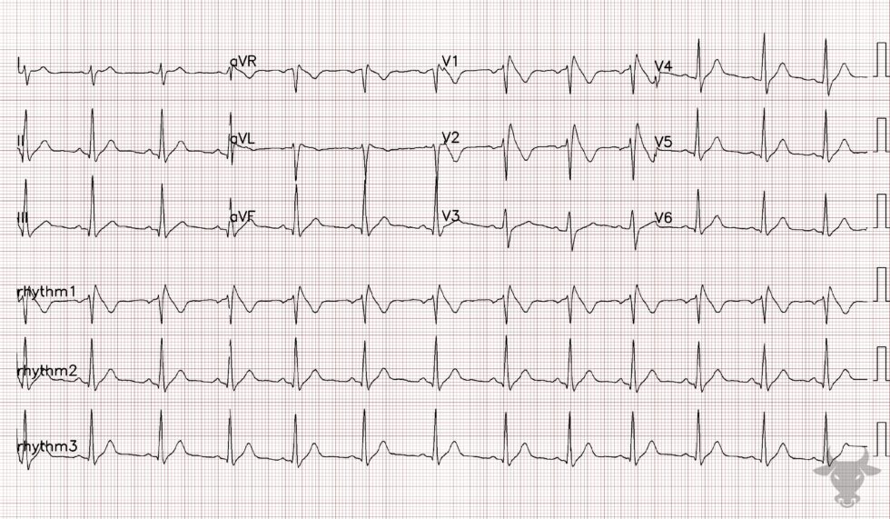 Brugada Syndrome | ECG Stampede