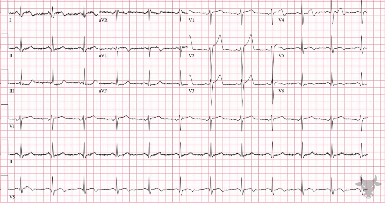 ST-elevation Myocardial Infarction | ECG Stampede