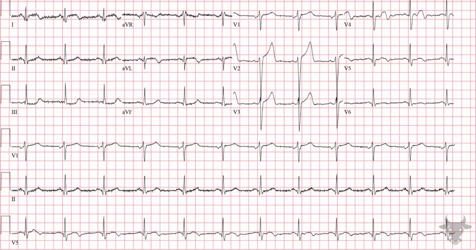 ST-elevation Myocardial Infarction | ECG Stampede