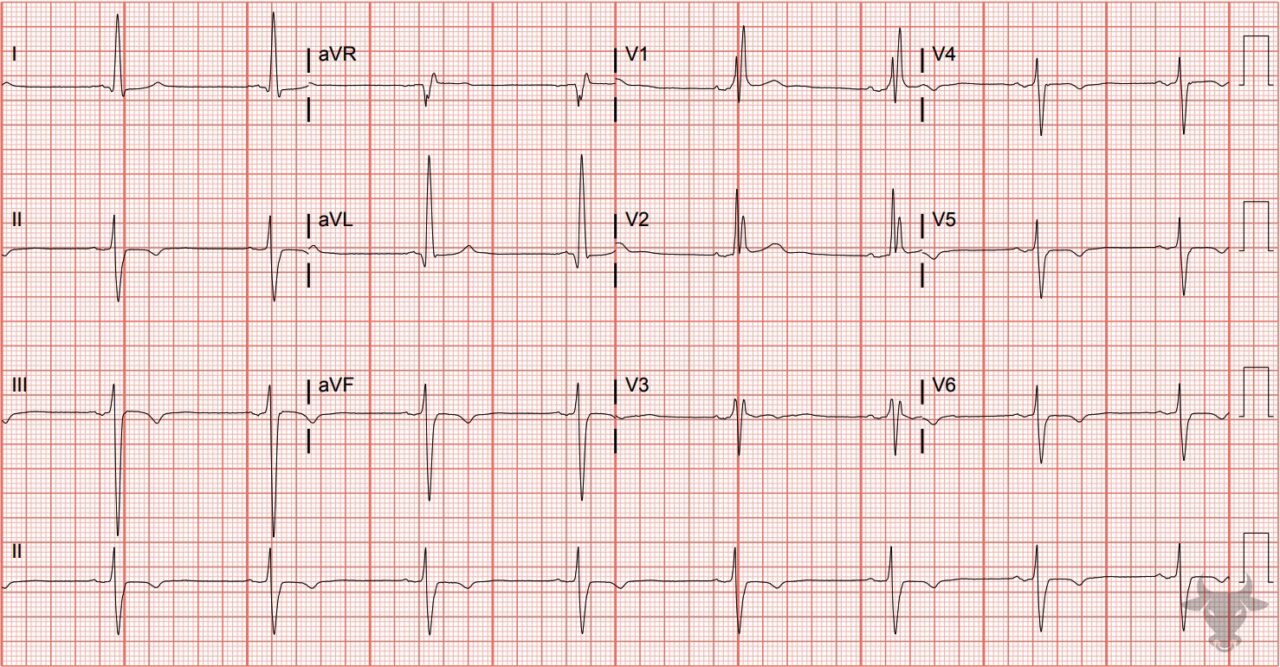 Left Anterior Fascicular Block | ECG Stampede