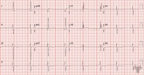 Right Bundle Branch Block | ECG Stampede