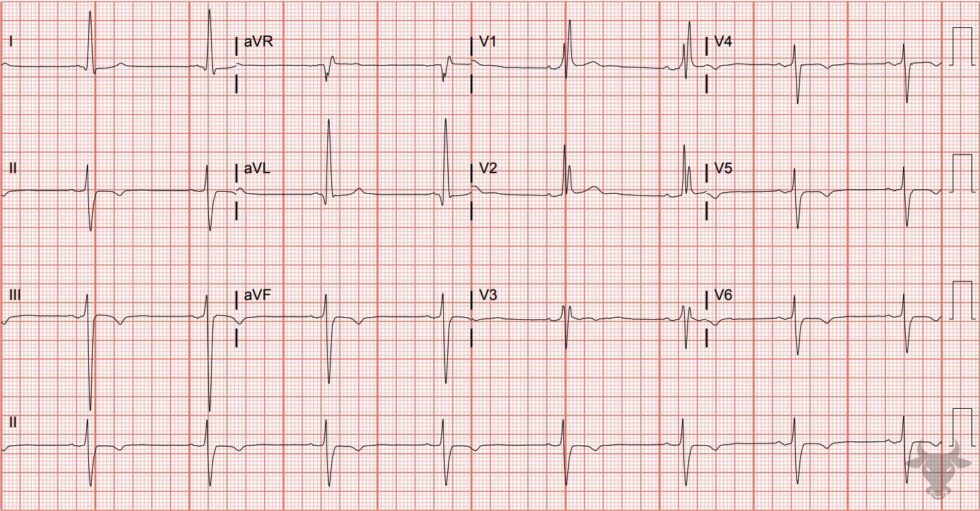Right Bundle Branch Block | ECG Stampede