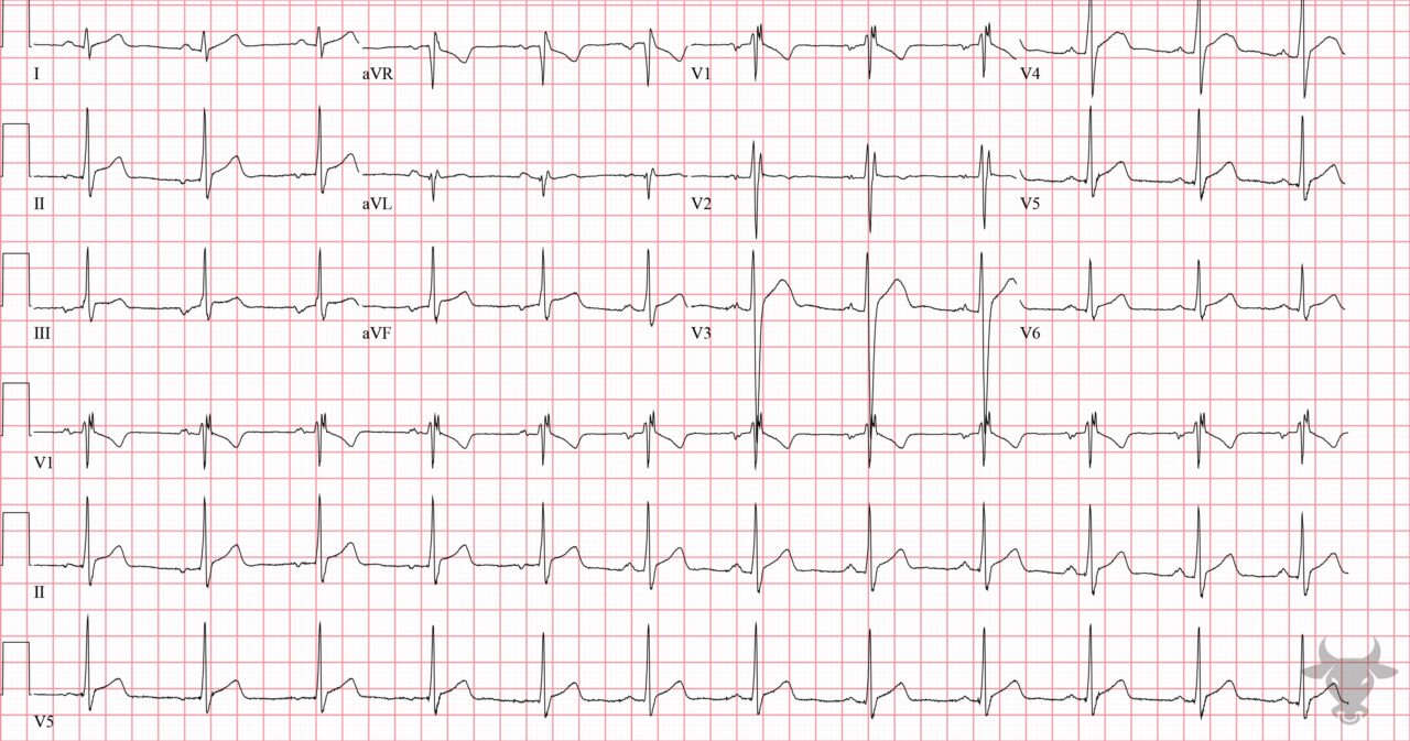 Right Bundle Branch Block | ECG Stampede