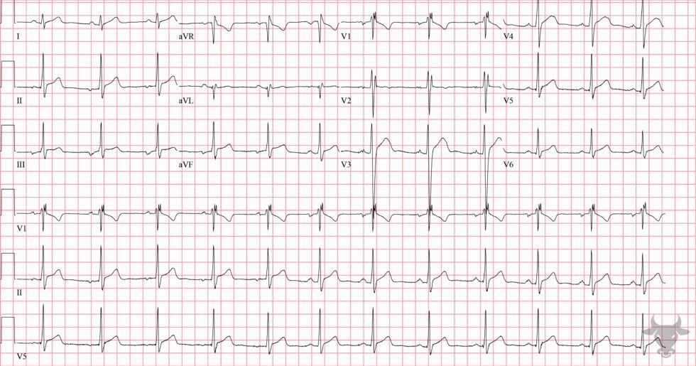 Right Bundle Branch Block | ECG Stampede