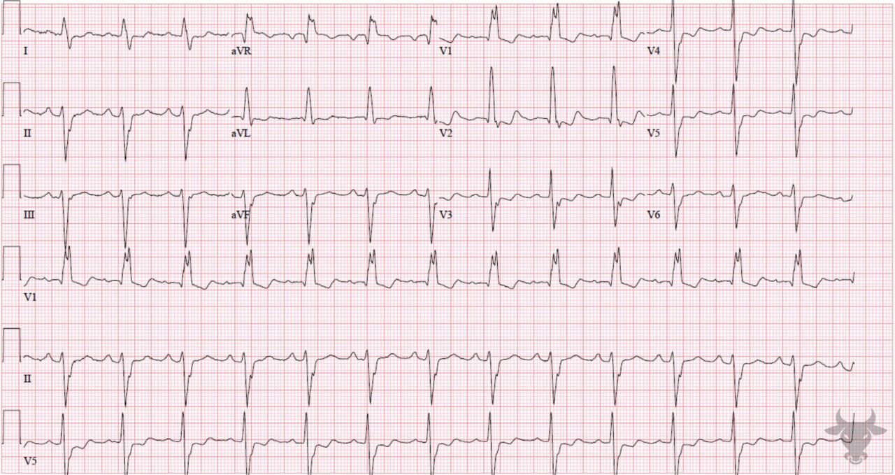 Trifascicular Block | ECG Stampede