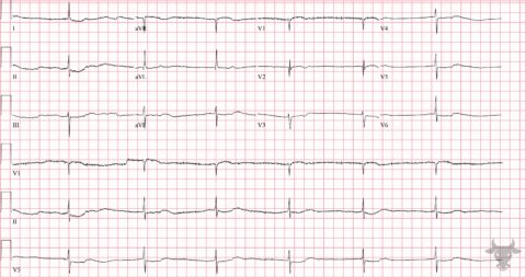 Hyperkalemia | ECG Stampede