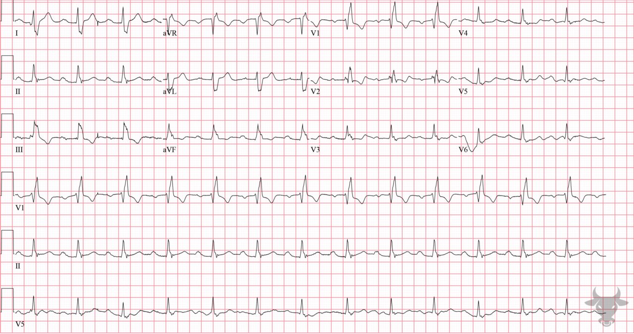 Right Bundle Branch Block | ECG Stampede