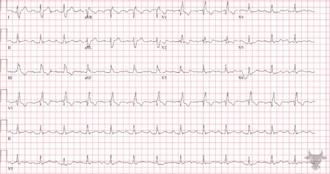 Right Bundle Branch Block | ECG Stampede