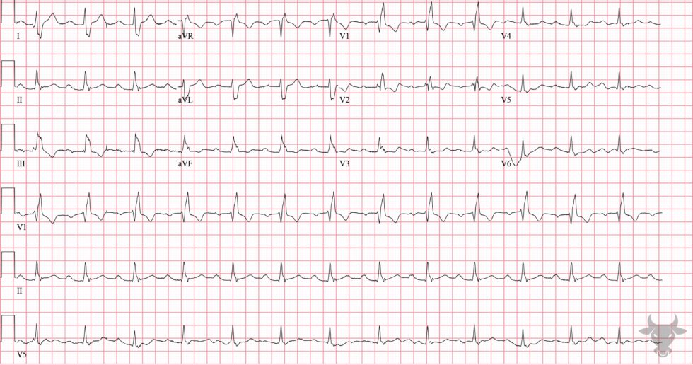 Right Bundle Branch Block | ECG Stampede