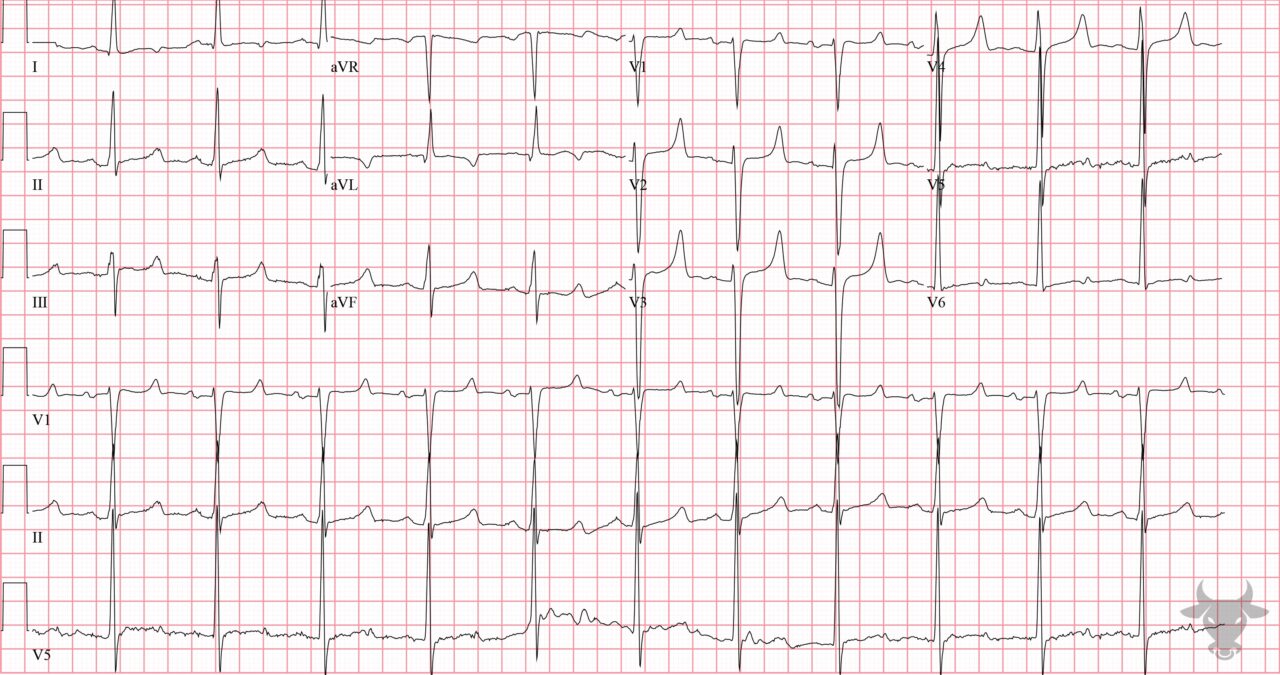 Hyperkalemia | ECG Stampede