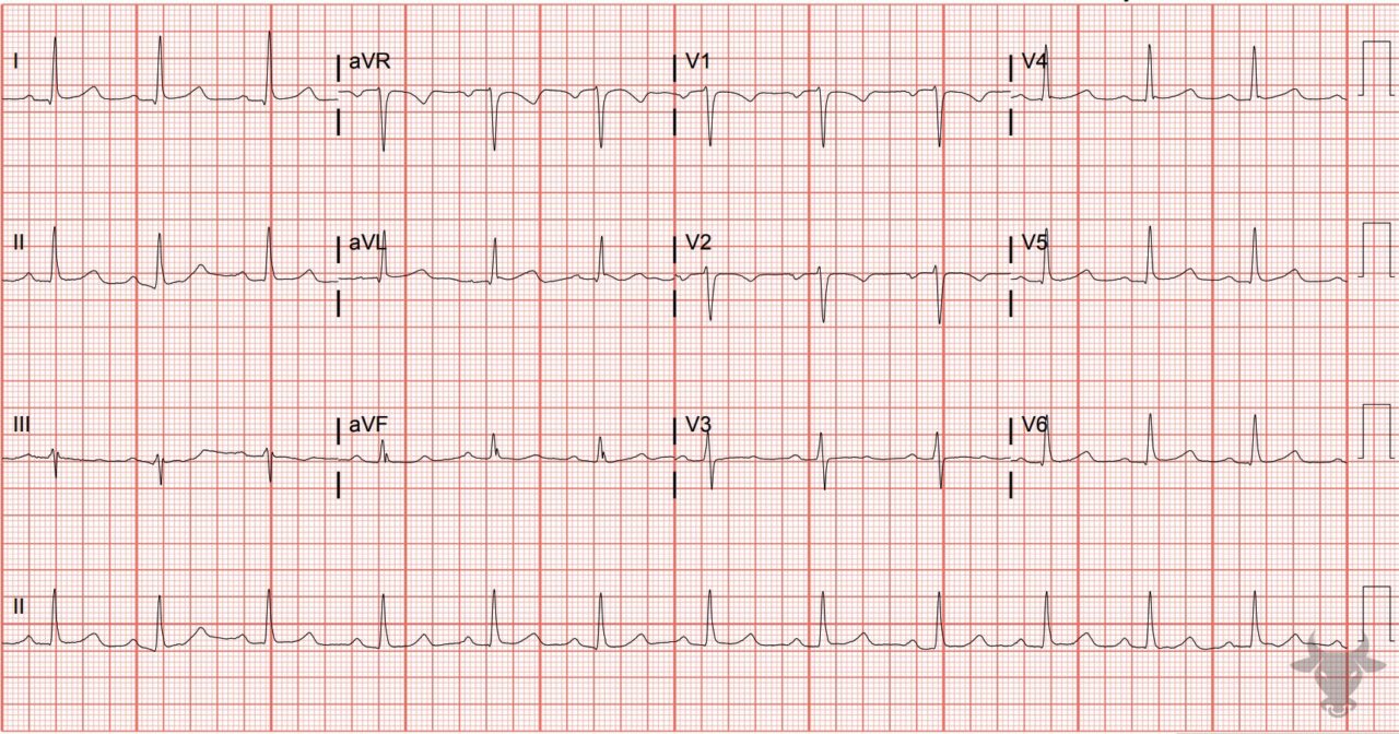 First Degree Atrioventricular Block | ECG Stampede
