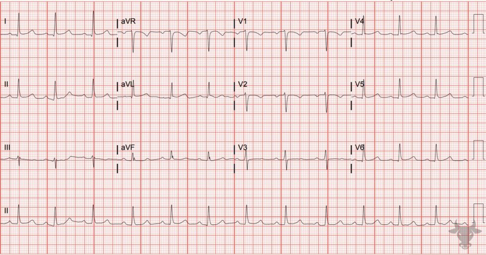 First Degree Atrioventricular Block | ECG Stampede