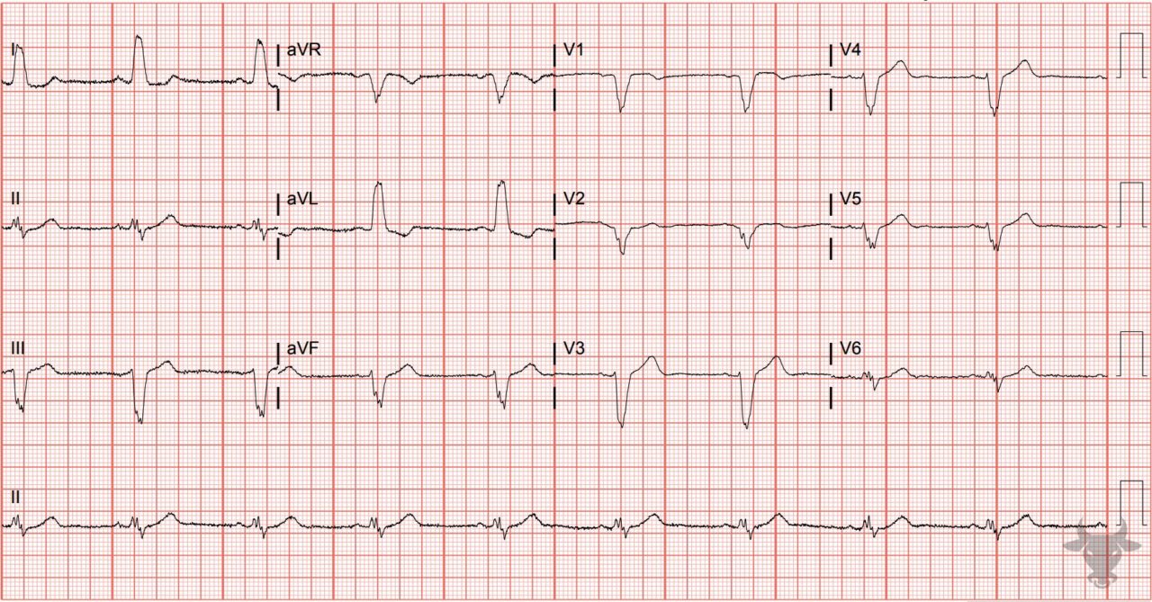 Left Bundle Branch Block | ECG Stampede