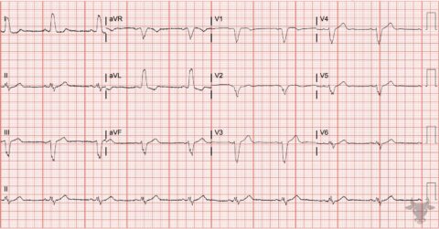 Left Bundle Branch Block | ECG Stampede