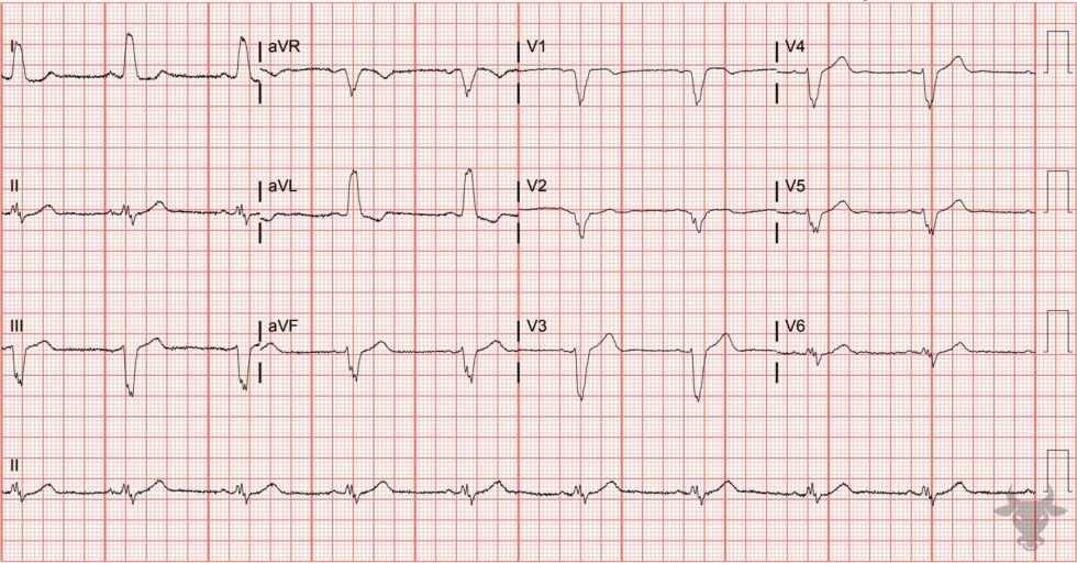 Left Bundle Branch Block | ECG Stampede