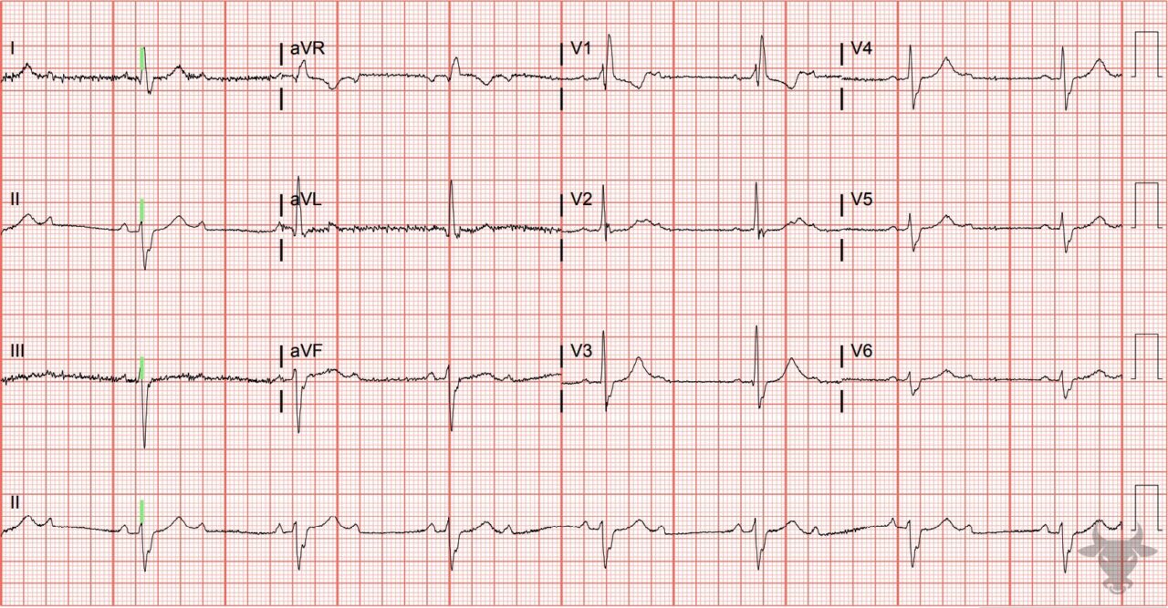 Second Degree Atrioventricular Block 2:1 | ECG Stampede