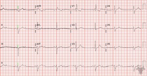 Left Anterior Fascicular Block | ECG Stampede