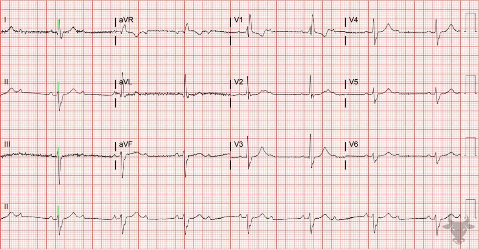 Left Anterior Fascicular Block | ECG Stampede