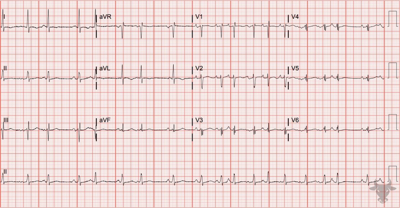 Multifocal Atrial Tachycardia | ECG Stampede