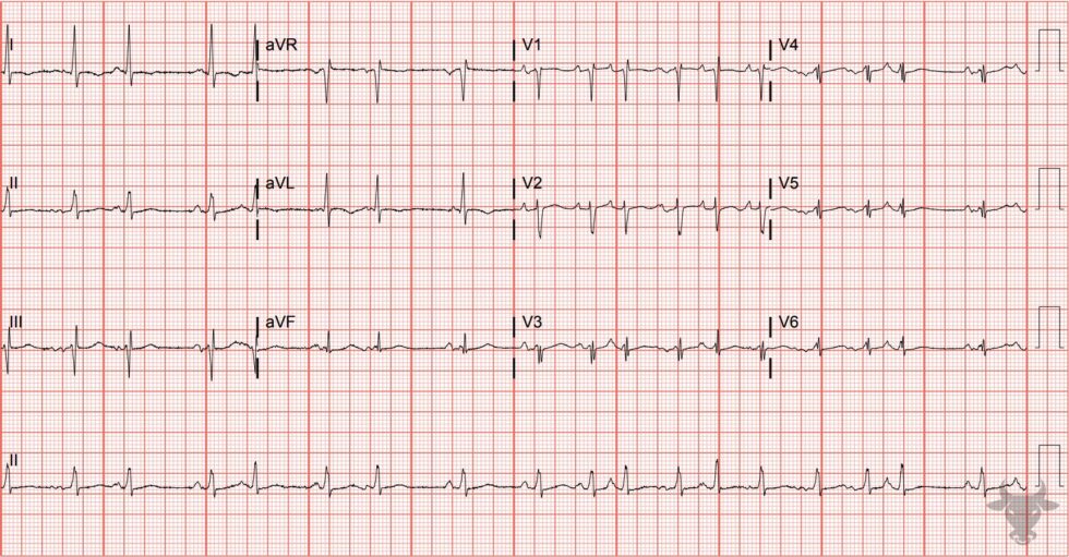 Multifocal Atrial Tachycardia | ECG Stampede