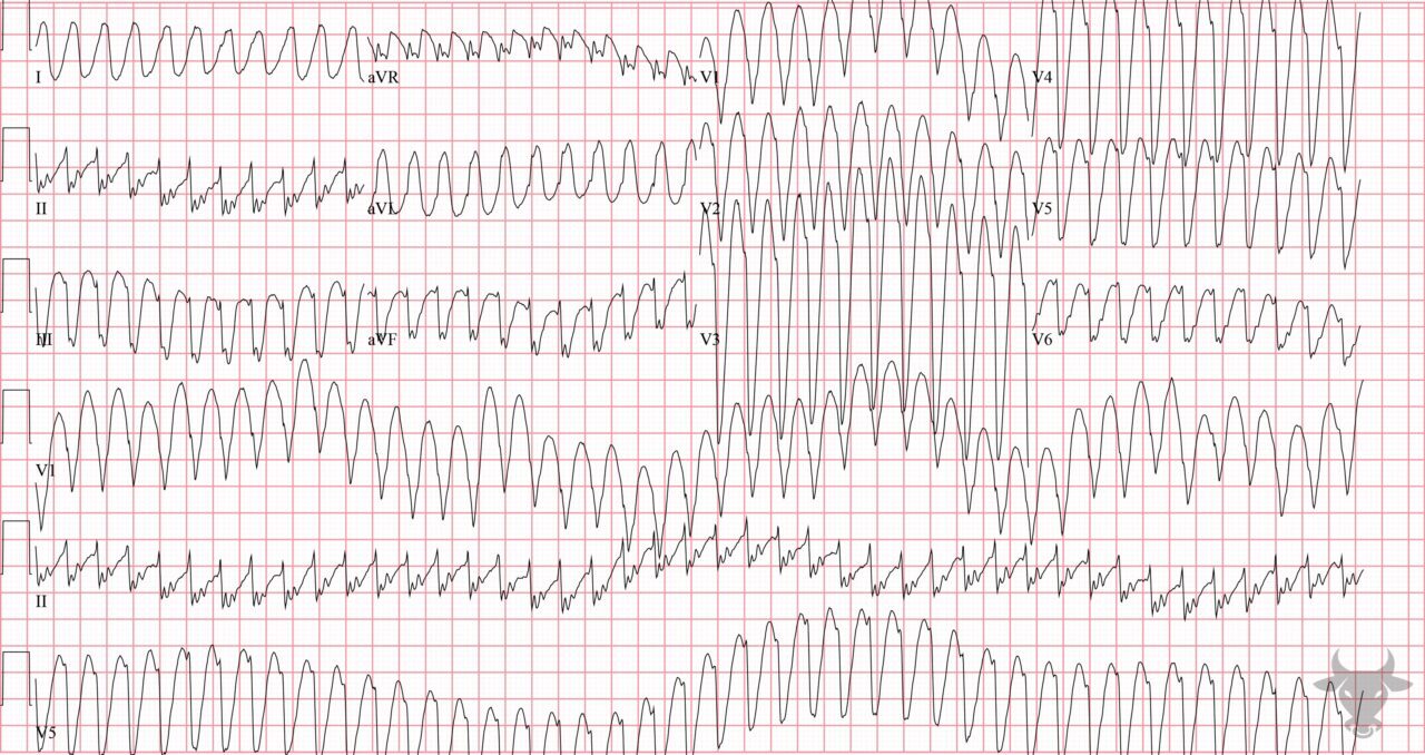 Ventricular Tachycardia | ECG Stampede