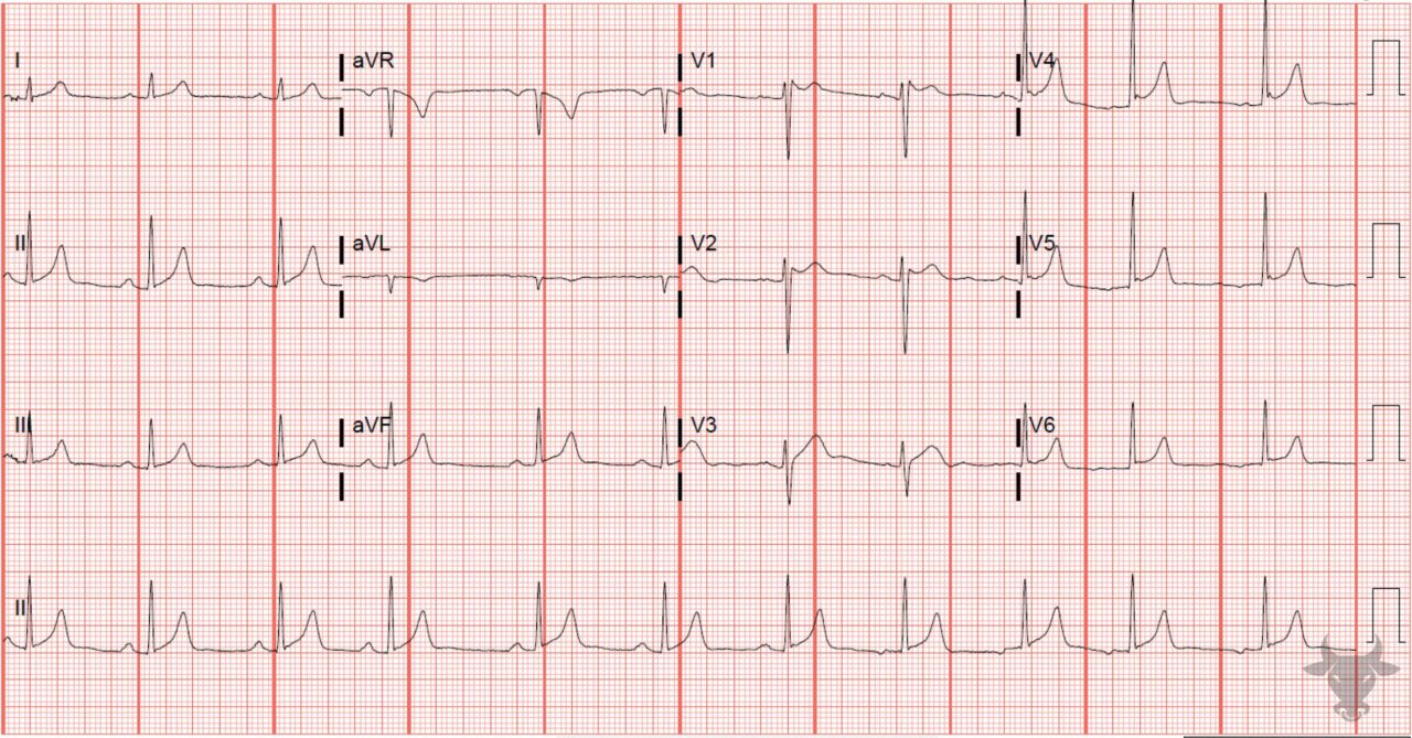 Right Bundle Branch Block | ECG Stampede