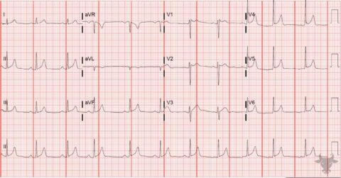 Right Bundle Branch Block | ECG Stampede