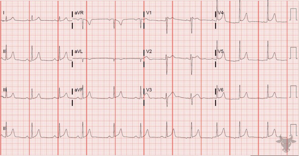 Right Bundle Branch Block | ECG Stampede