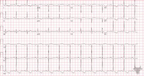 Left Atrial Enlargement | ECG Stampede