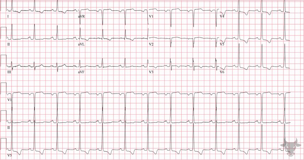 Hypertrophic Cardiomyopathy | ECG Stampede