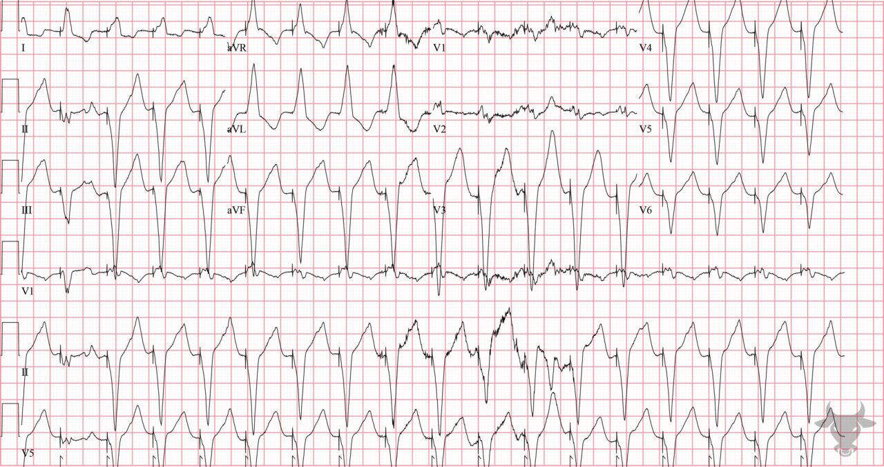 Pacemaker Mediated Tachycardia | ECG Stampede