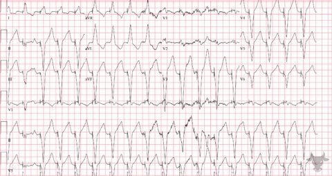 Pacemaker Malfunction | ECG Stampede