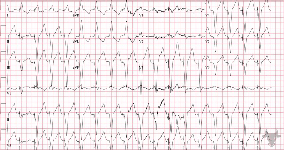 Pacemaker Malfunction | ECG Stampede