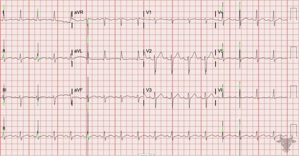 Pacemaker Malfunction | ECG Stampede