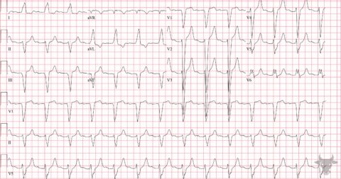Left Bundle Branch Block | ECG Stampede