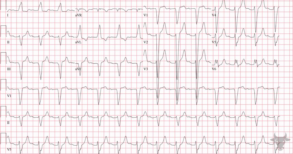 Left Bundle Branch Block | ECG Stampede