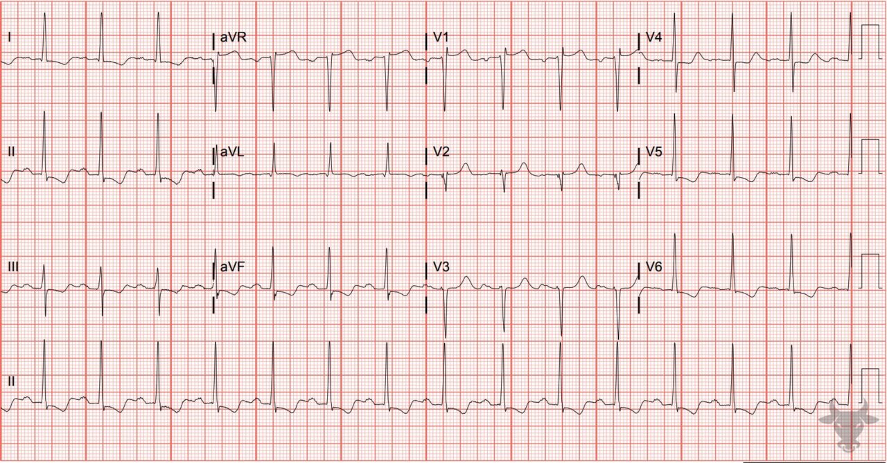 Left Ventricular Hypertrophy | ECG Stampede