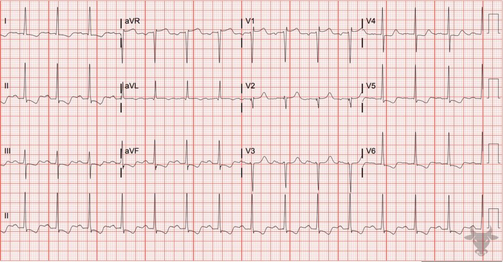 Left Ventricular Hypertrophy | ECG Stampede