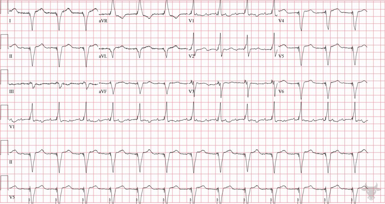 Paced Rhythms | ECG Stampede