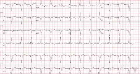 Paced Rhythms | ECG Stampede
