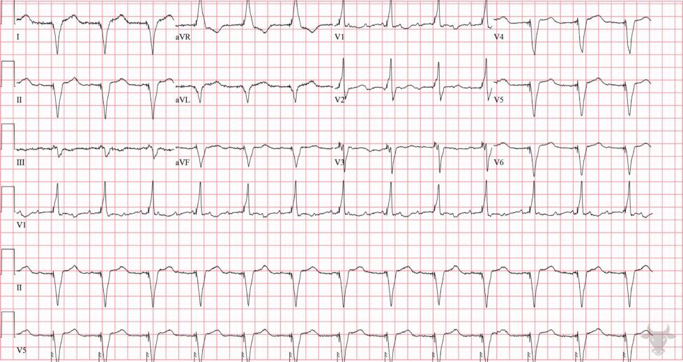 Paced Rhythms | ECG Stampede