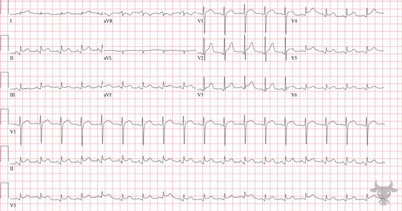 Acute Pericarditis | ECG Stampede