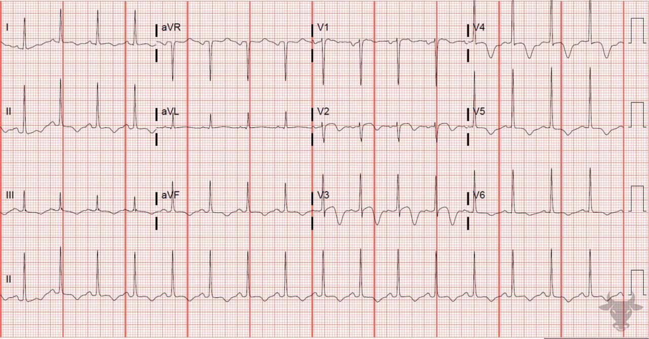 Wellens Syndrome | ECG Stampede