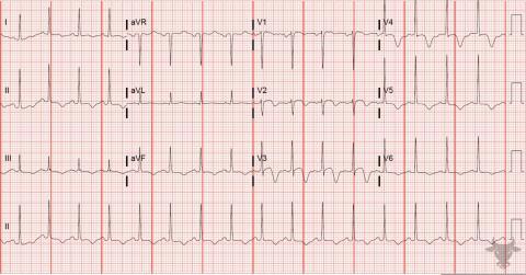 Wellens Syndrome | ECG Stampede