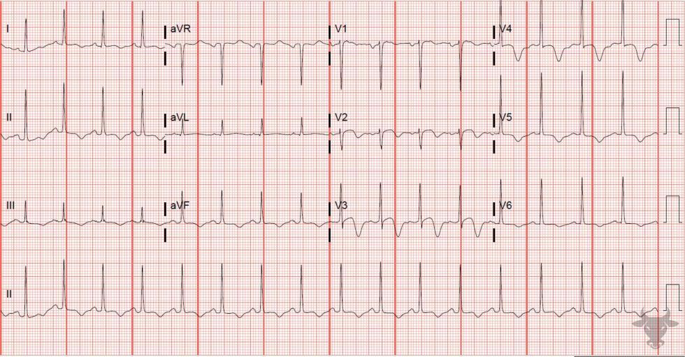 Wellens Syndrome | ECG Stampede