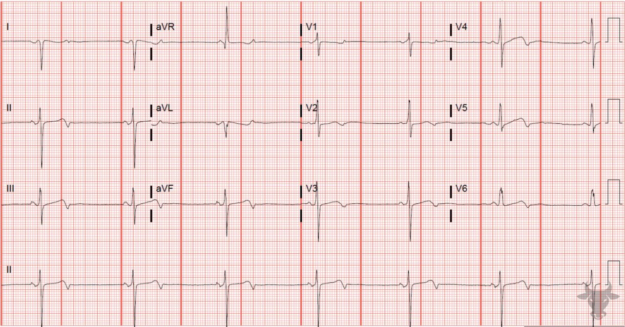 Limb Lead Reversal | ECG Stampede