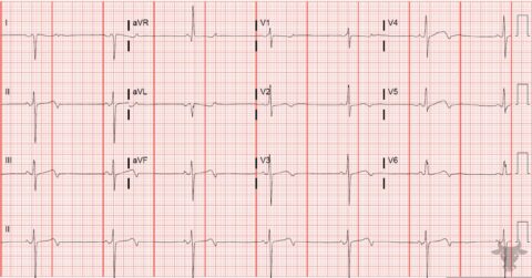 Limb Lead Reversal | ECG Stampede