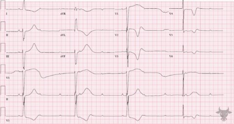 Third Degree Atrioventricular Block | ECG Stampede