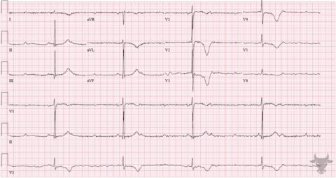 Second Degree Atrioventricular Block – Mobitz II | ECG Stampede